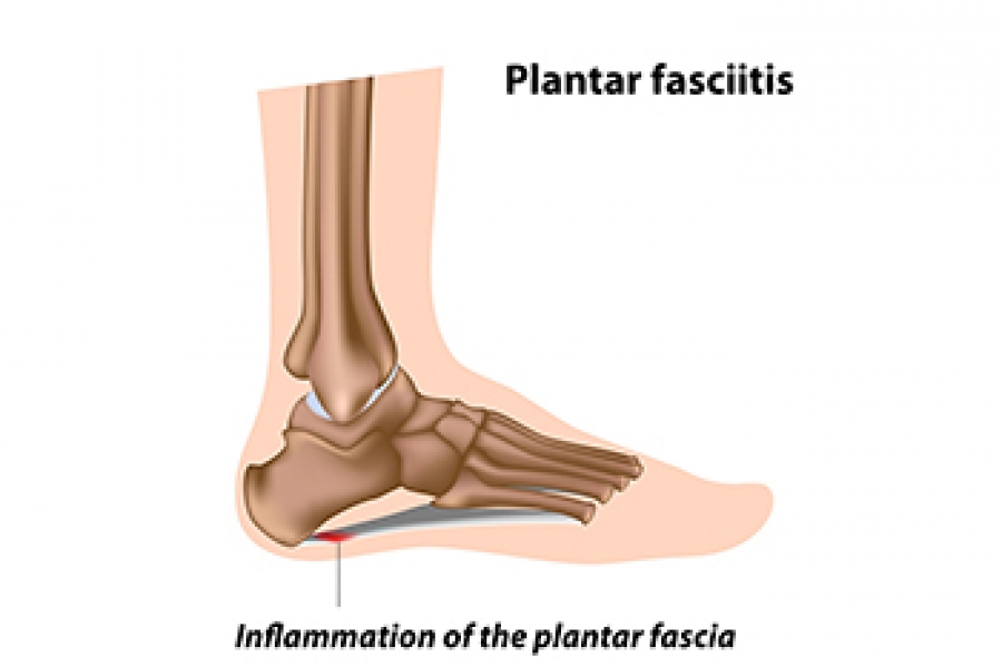 Causes of Plantar Fasciitis